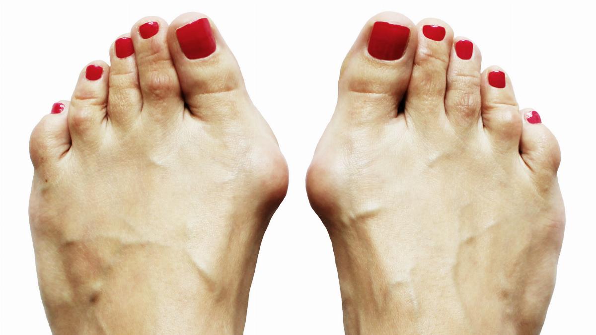 Alluce valgo: rimedi naturali e prevenzione - Il futuro è adesso